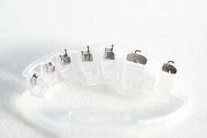 Digital Indirect Bonding - The Brace Space